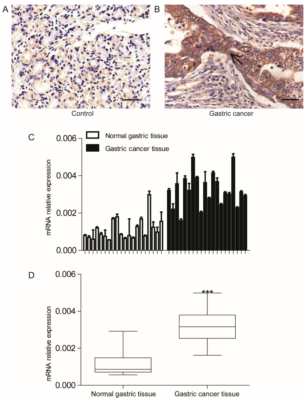 Deregulated SLC2A1 Promotes Tumor Cell Proliferation and Metastasis in ...