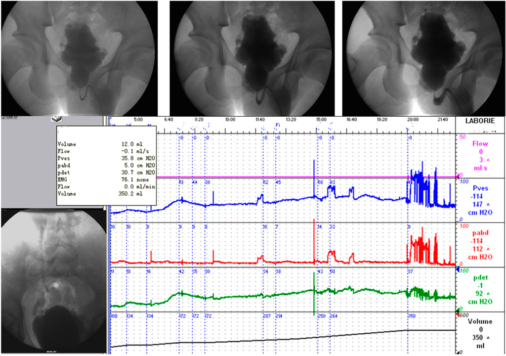 Evaluation and Management of Neurogenic Bladder: What Is New in China?