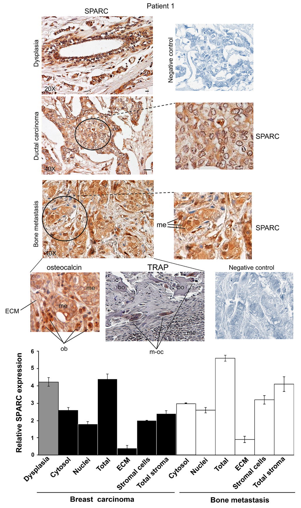 High SPARC Expression Starting from Dysplasia, Associated with Breast ...