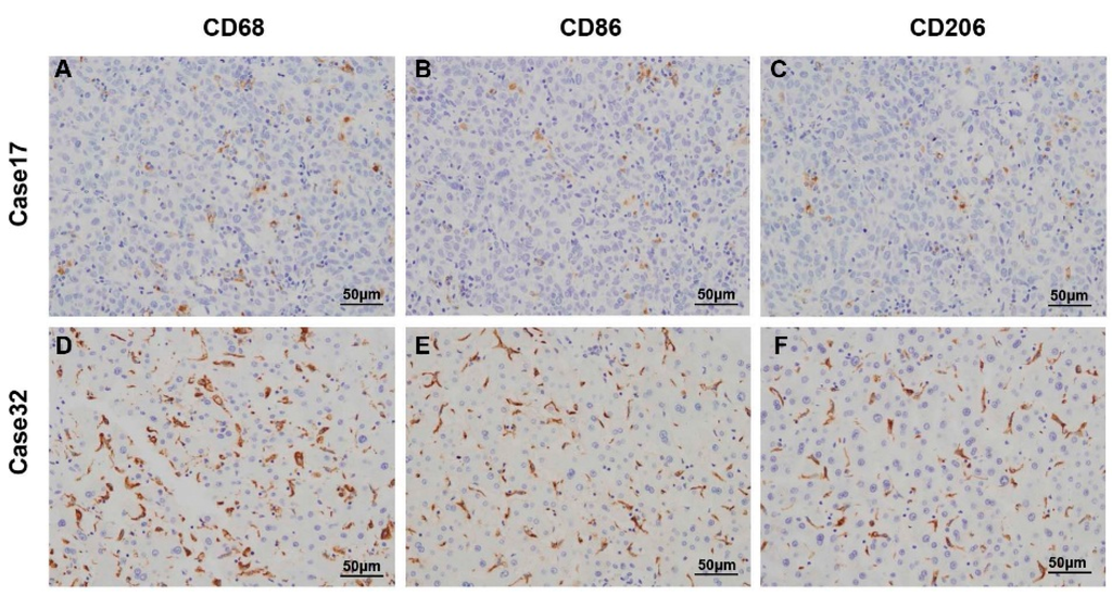 CD86+/CD206+, Diametrically Polarized Tumor-Associated Macrophages ...