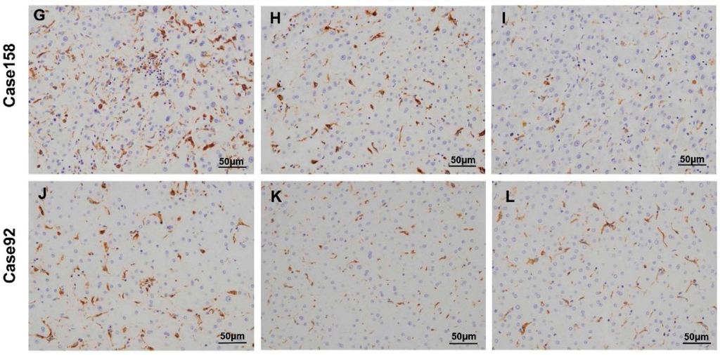 CD86+/CD206+, Diametrically Polarized Tumor-Associated Macrophages ...