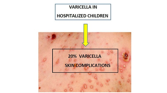 IJMS | Free Full-Text | Varicella Skin Complications in Childhood: A ...
