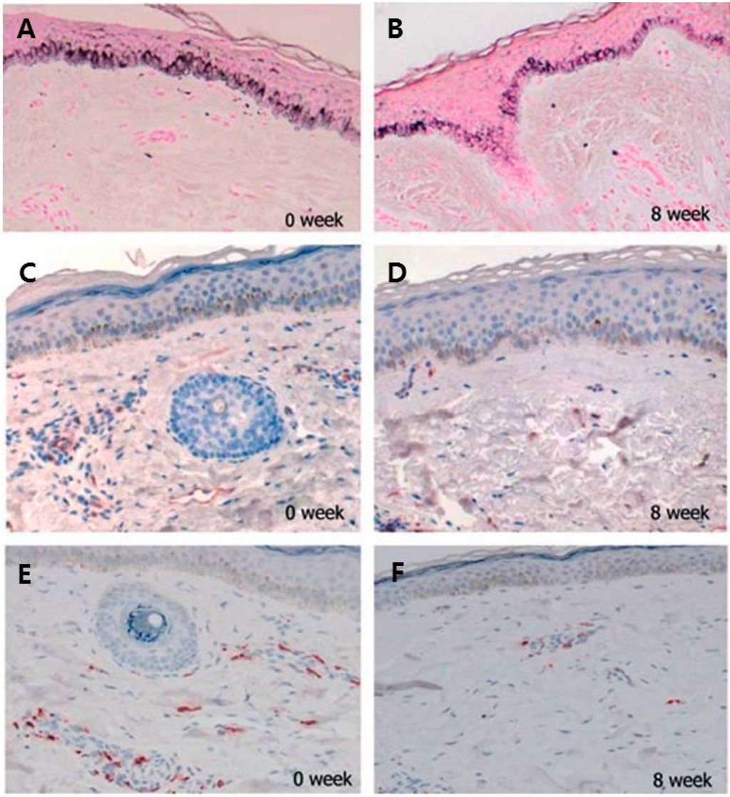 Heterogeneous Pathology of Melasma and Its Clinical Implications