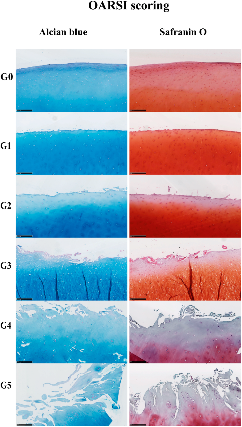 Correlation between Gene Expression and Osteoarthritis Progression in Human