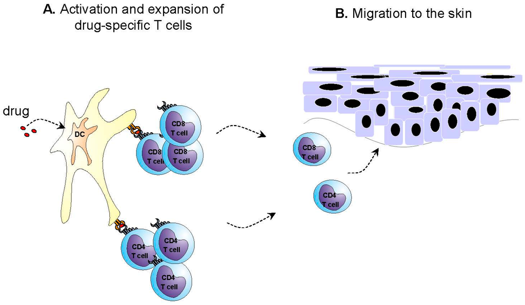 Acute Generalized Exanthematous Pustulosis: Pathogenesis, Genetic ...