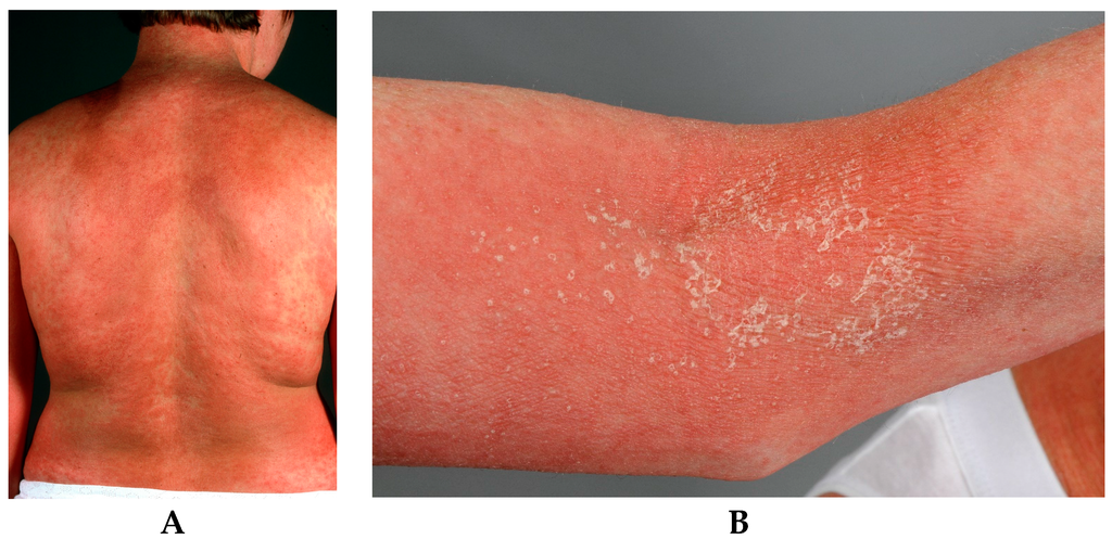 IJMS | Special Issue : Inflammatory Skin Conditions