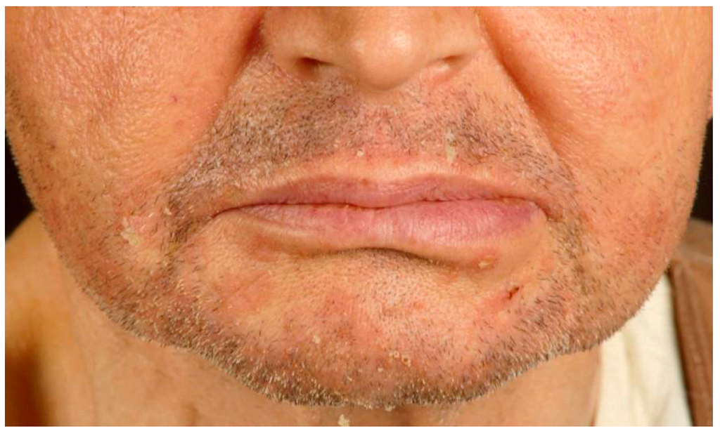 IJMS | Special Issue : Inflammatory Skin Conditions