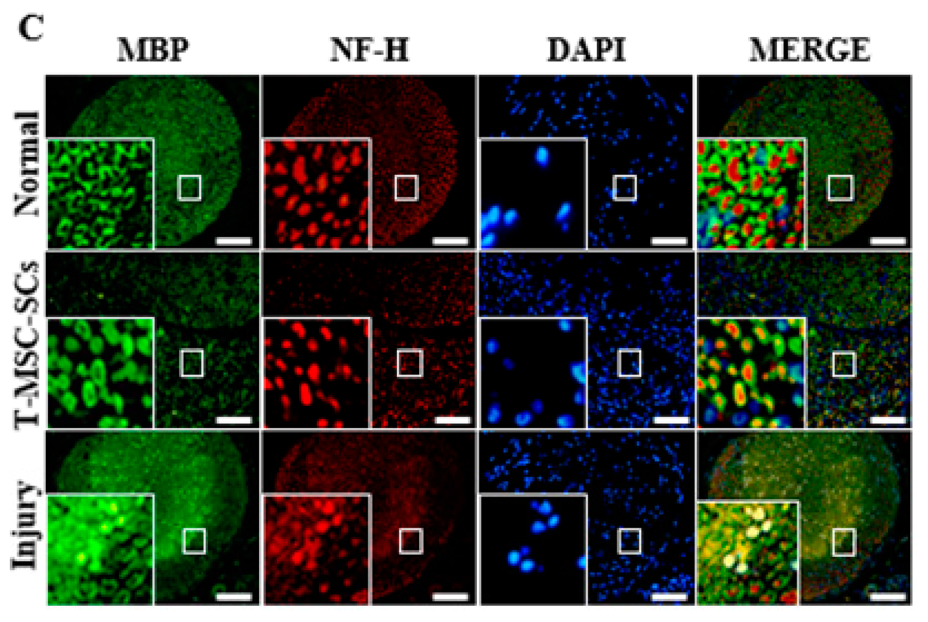Tonsil-Derived Mesenchymal Stem Cells Differentiate into a Schwann Cell ...