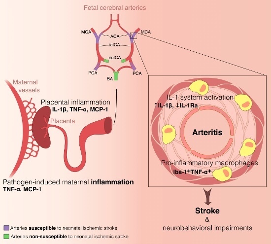 IJMS | Free Full-Text | Perinatal Arterial Ischemic Stroke Is ...
