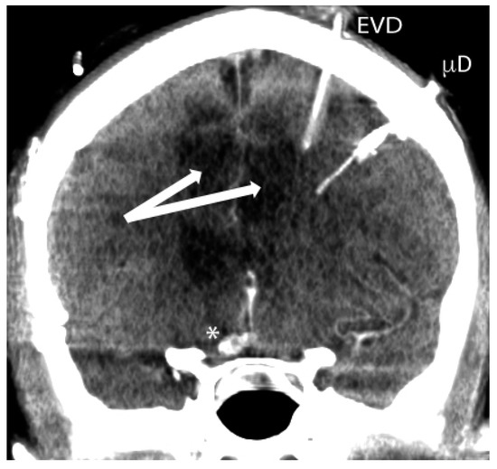 IJMS | Free Full-Text | Brain Monitoring in Critically Neurologically ...