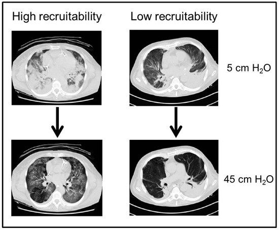 IJMS | Special Issue : Pneumonia: Pathogenesis, Diagnostics ... IJMS | Special Issue : Pneumonia: Pathogenesis, Diagnostics ...