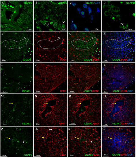 IQGAP1 in Podosomes/Invadosomes Is Involved in the Progression of ...