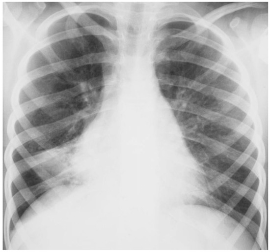Recurrent Pneumonia in Children: A Reasoned Diagnostic Approach and a ...