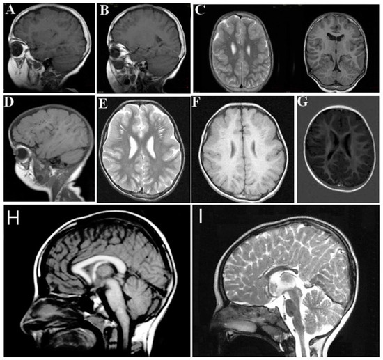 Discriminative Features in Three Autosomal Recessive Cutis Laxa ...