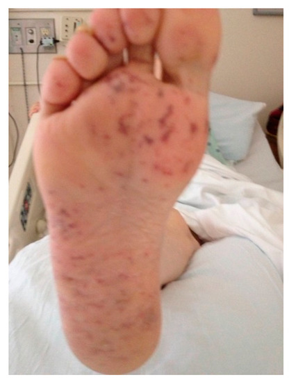 Cholesterol Crystal Embolism and Chronic Kidney Disease