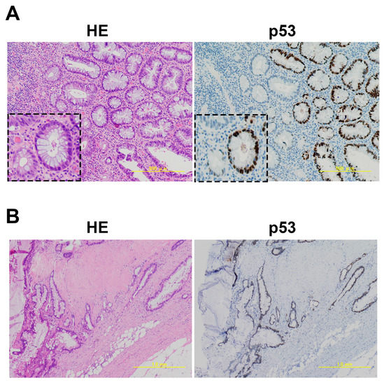 p53 Expression as a Diagnostic Biomarker in Ulcerative Colitis ...