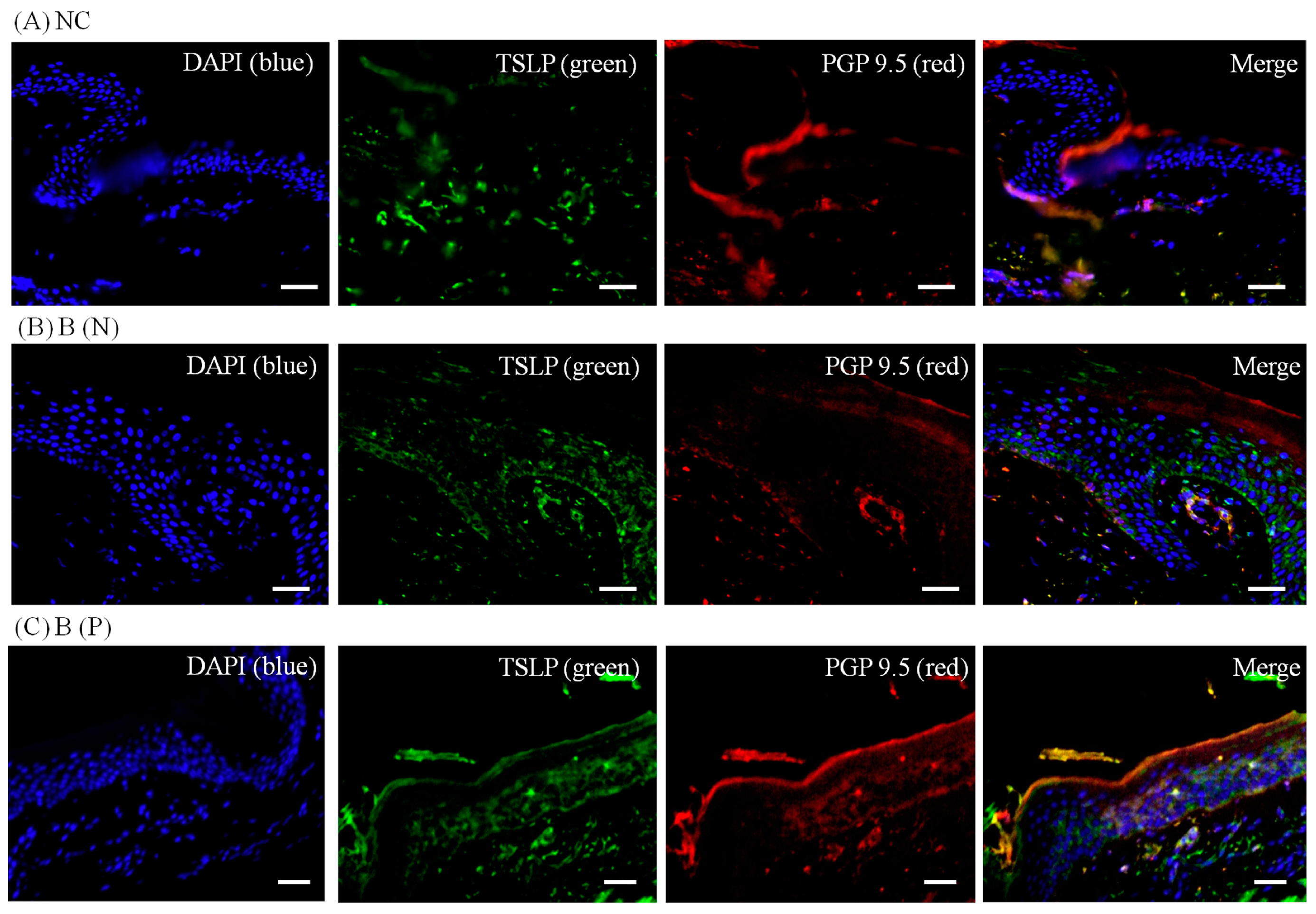 TRPV3 Channel in Keratinocytes in Scars with Post-Burn Pruritus