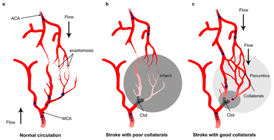 Improving Cerebral Blood Flow after Arterial Recanalization: A Novel ...