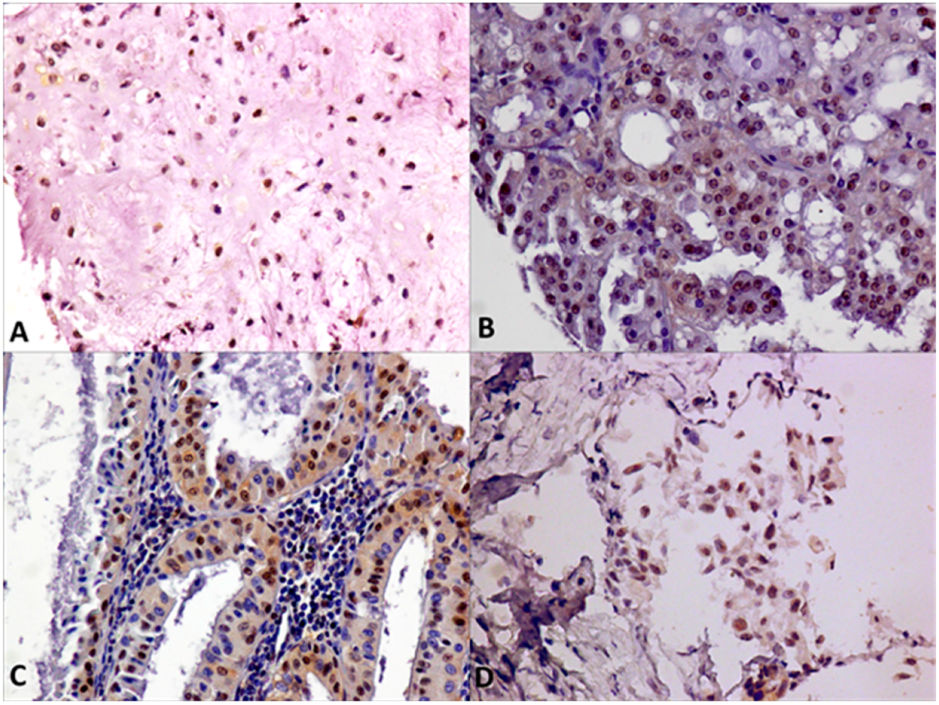 Ijms Free Full Text Sex Hormone Receptors In Benign And Malignant
