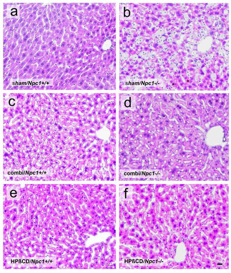 Niemann Pick Foam Cells
