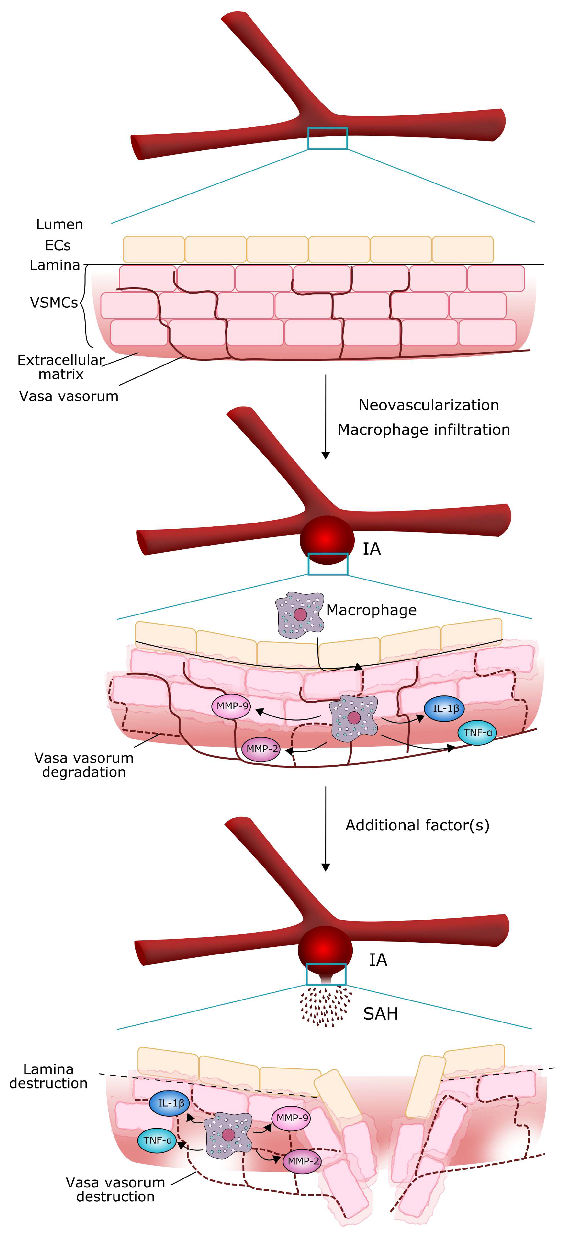 IJMS | Free Full-Text | NF-κB-Mediated Inflammation in the Pathogenesis of Intracranial Aneurysm ...