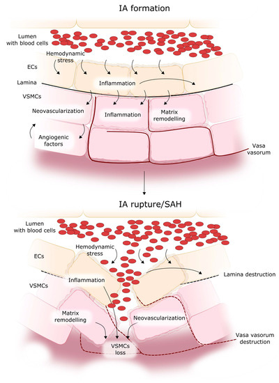IJMS | Free Full-Text | NF-κB-Mediated Inflammation in the Pathogenesis of Intracranial Aneurysm ...