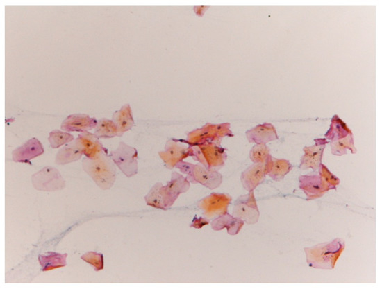 A Noninvasive Test for MicroRNA Expression in Oral Squamous Cell Carcinoma