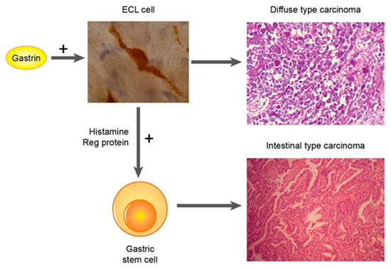 Types of Gastric Carcinomas