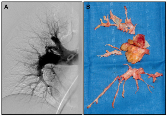 Molecular Research in Chronic Thromboembolic Pulmonary Hypertension