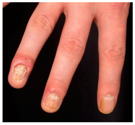 Psoriasis Pathogenesis and Treatment