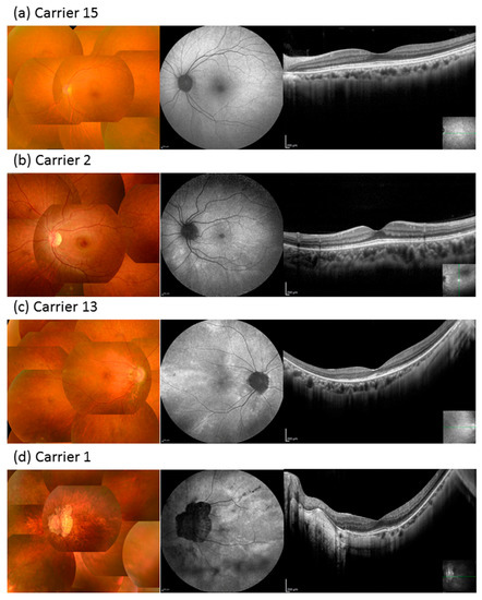 X-linked Retinitis Pigmentosa in Japan: Clinical and Genetic Findings ...