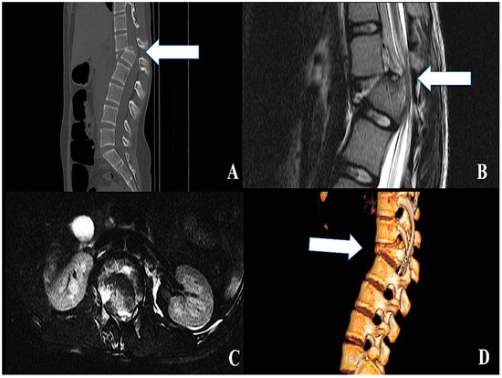 IJMS | Free Full-Text | Acute Spinal Cord Injury: A Systematic Review ...