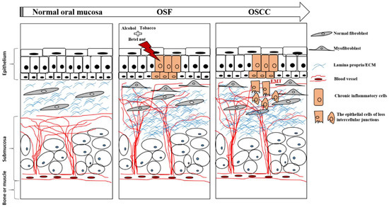 Oral Submucous Fibrosis: A Review on Etiopathogenesis, Diagnosis, and ...