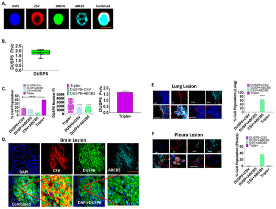 Nuclear-Biased DUSP6 Expression is Associated with Cancer Spreading ...