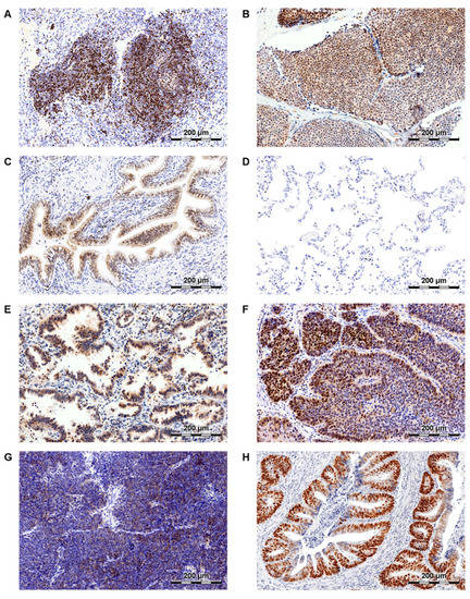 The Role of SATB1 in Tumour Progression and Metastasis