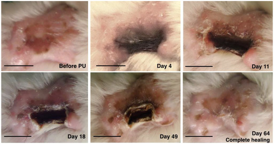 Local Growth Hormone Therapy for Pressure Ulcer Healing on a Human Skin ...