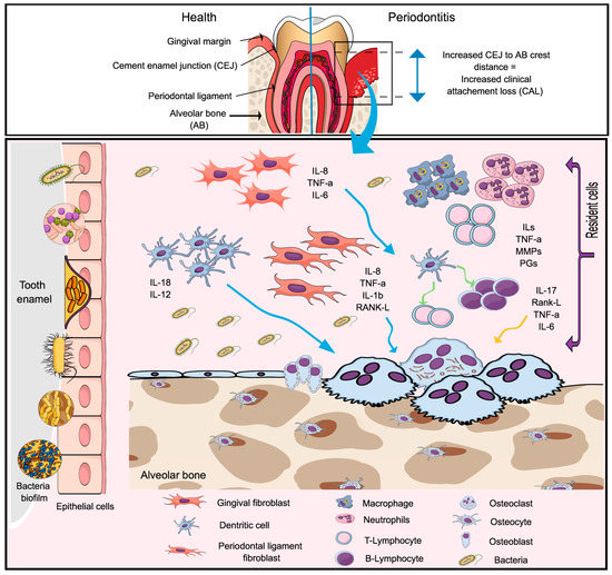 IJMS | Free Full-Text | Linkage of Periodontitis and Rheumatoid ...
