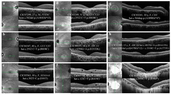 Phenotype Analysis of Retinal Dystrophies in Light of the Underlying ...