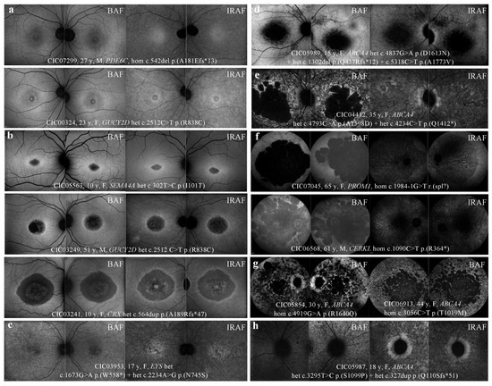 Phenotype Analysis of Retinal Dystrophies in Light of the Underlying ...