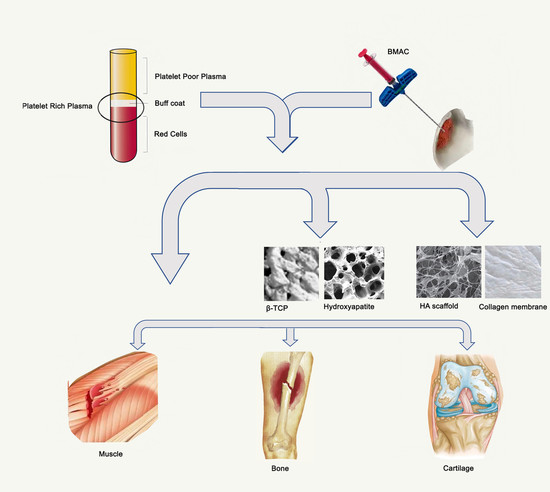 IJMS | Free Full-Text | PRP and BMAC for Musculoskeletal Conditions via Biomaterial Carriers