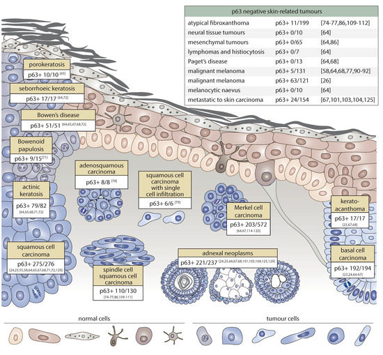 p63 Is a Promising Marker in the Diagnosis of Unusual Skin Cancer