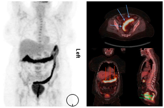 Imaging Inflammation and Infection in the Gastrointestinal Tract
