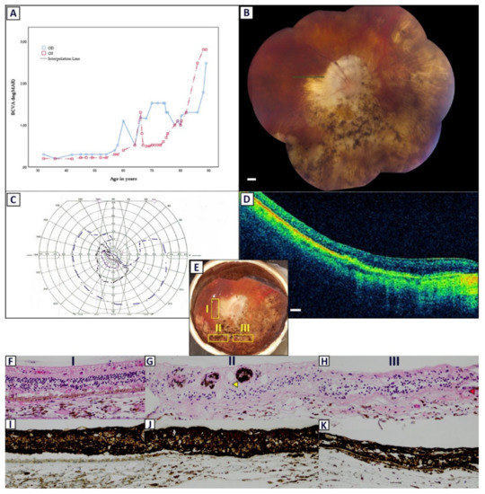 IJMS | Special Issue : Retinal Degeneration: From Pathophysiology to ...
