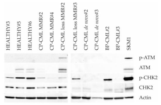 DNA Damage and DNA Damage Response in Chronic Myeloid Leukemia