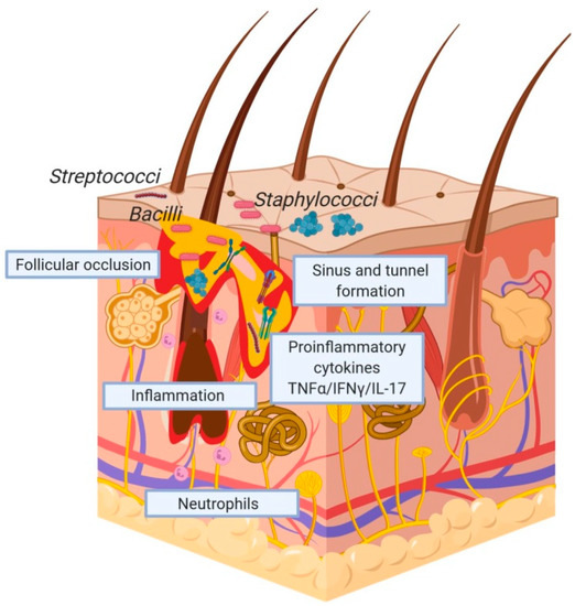 The Role of the Cutaneous Microbiome in Hidradenitis Suppurativa—Light ...