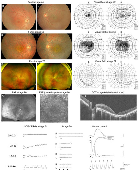 IJMS | Special Issue : Inherited Retinal Diseases: How Can We Move ...