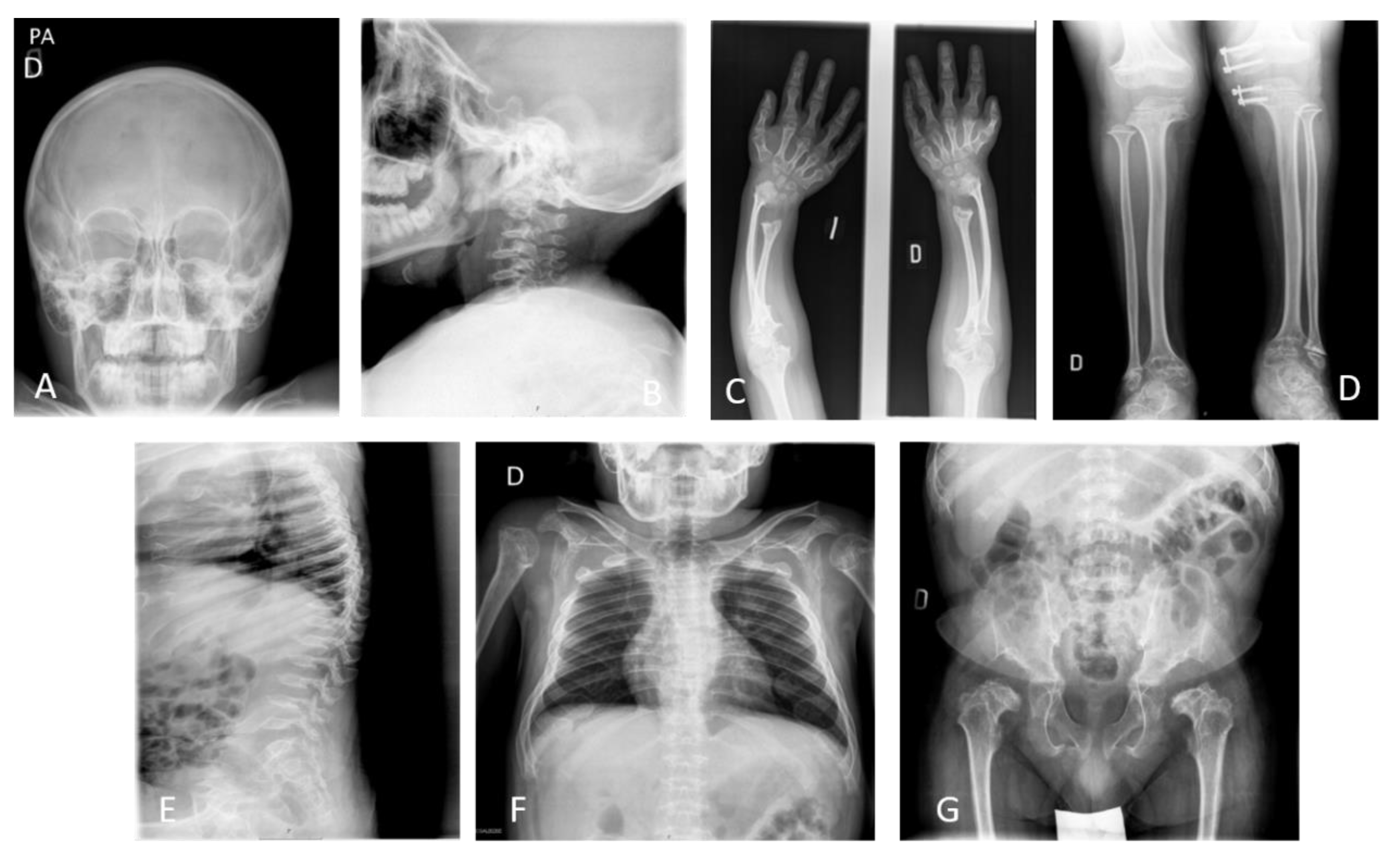 Mucopolysaccharidosis IVA: Diagnosis, Treatment, and Management