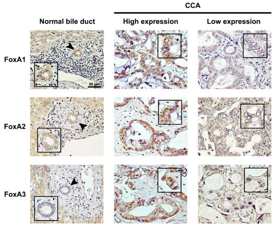 Opposing Roles of FoxA1 and FoxA3 in Intrahepatic Cholangiocarcinoma ...