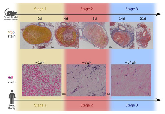 Resolution of Deep Venous Thrombosis: Proposed Immune Paradigms