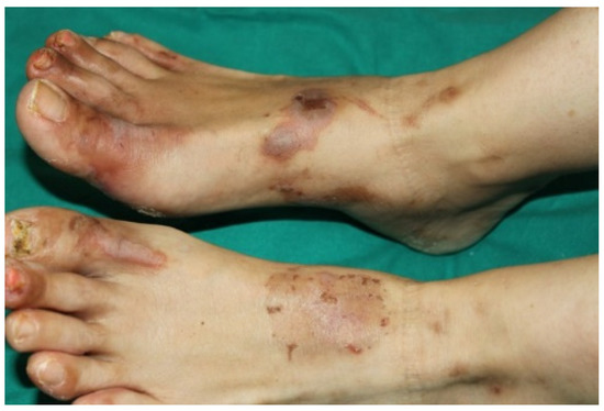 Paraneoplastic Dermatoses: A Brief General Review and an Extensive ...
